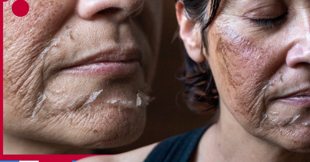Phenol peeling: what it consists of and what experts recommend
